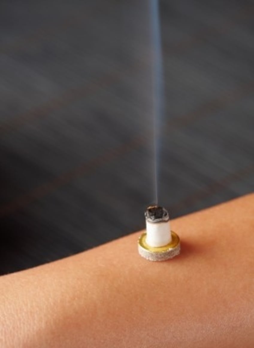 Electro-Acupuncture for Tennis Elbow - The Acupuncture Clinic