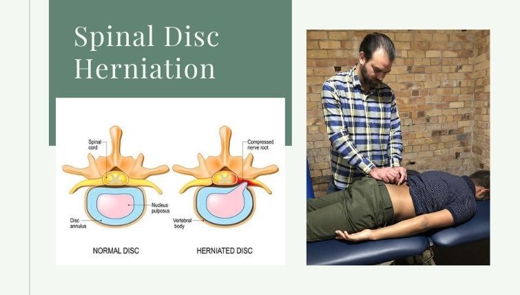 Acupuncture for Herniated and Prolapsed Disc - The Acupuncture Clinic