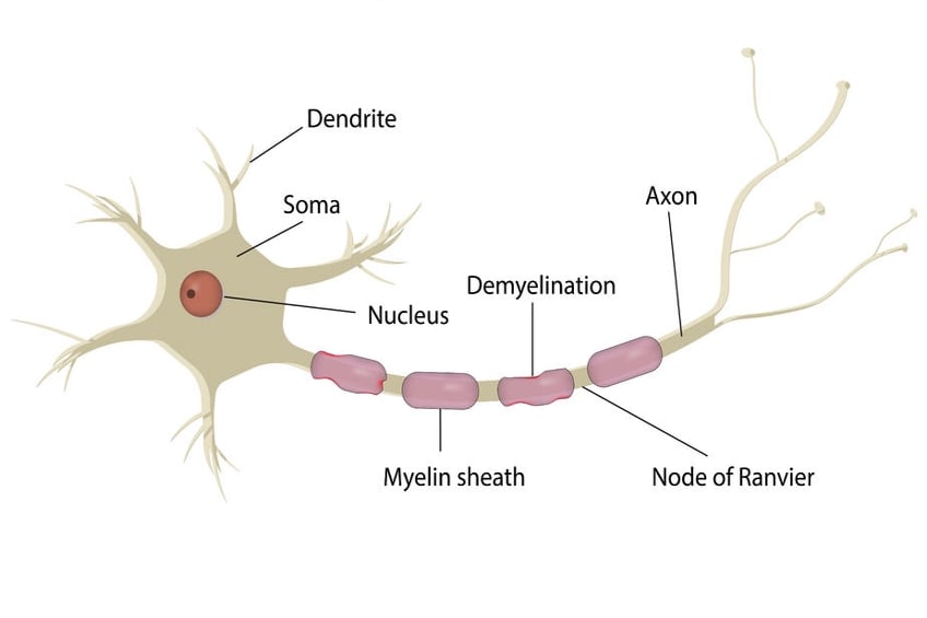 Multiple Sclerosis – Revisited - The Acupuncture Clinic