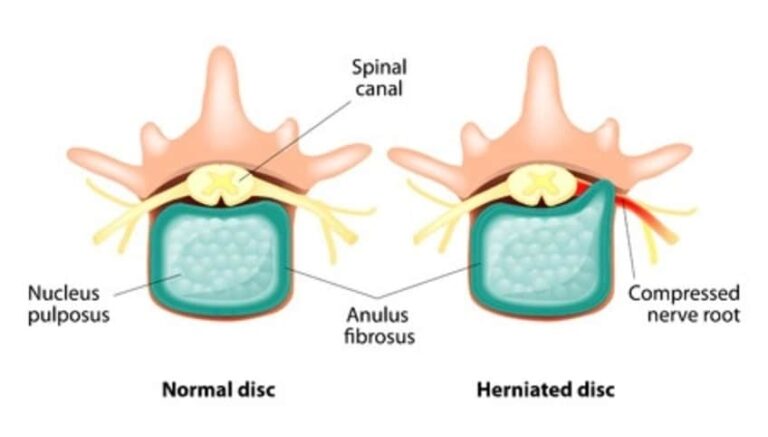 Acupuncture treatment for disc herniation - The Acupuncture Clinic