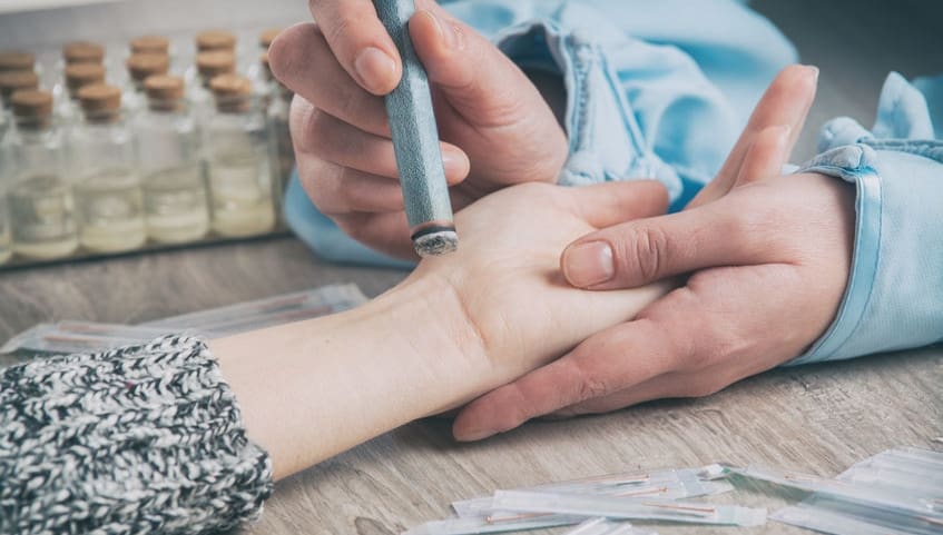 What is Moxibustion? - The Acupuncture Clinic
