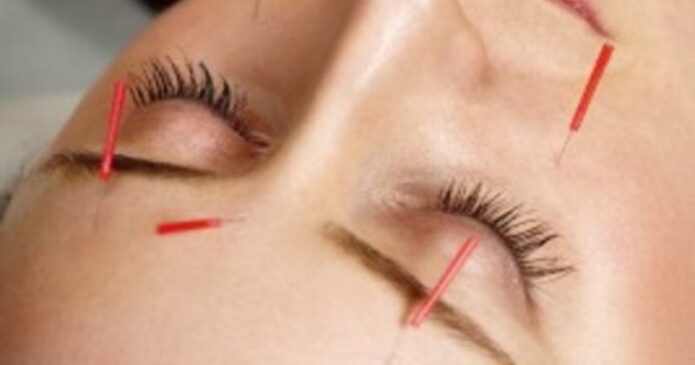 Hayfever & Sinus and Acupuncture - The Acupuncture Clinic